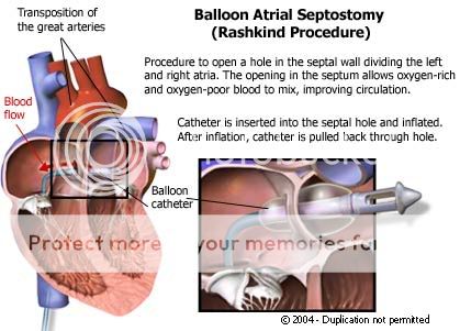 Balloon Atrial Septostomy (Rashkind Procedure) Photo by jennifergalyean ...